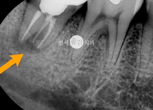 어금니 잇몸 통증 원인에 따른 치료법 네이버 블로그